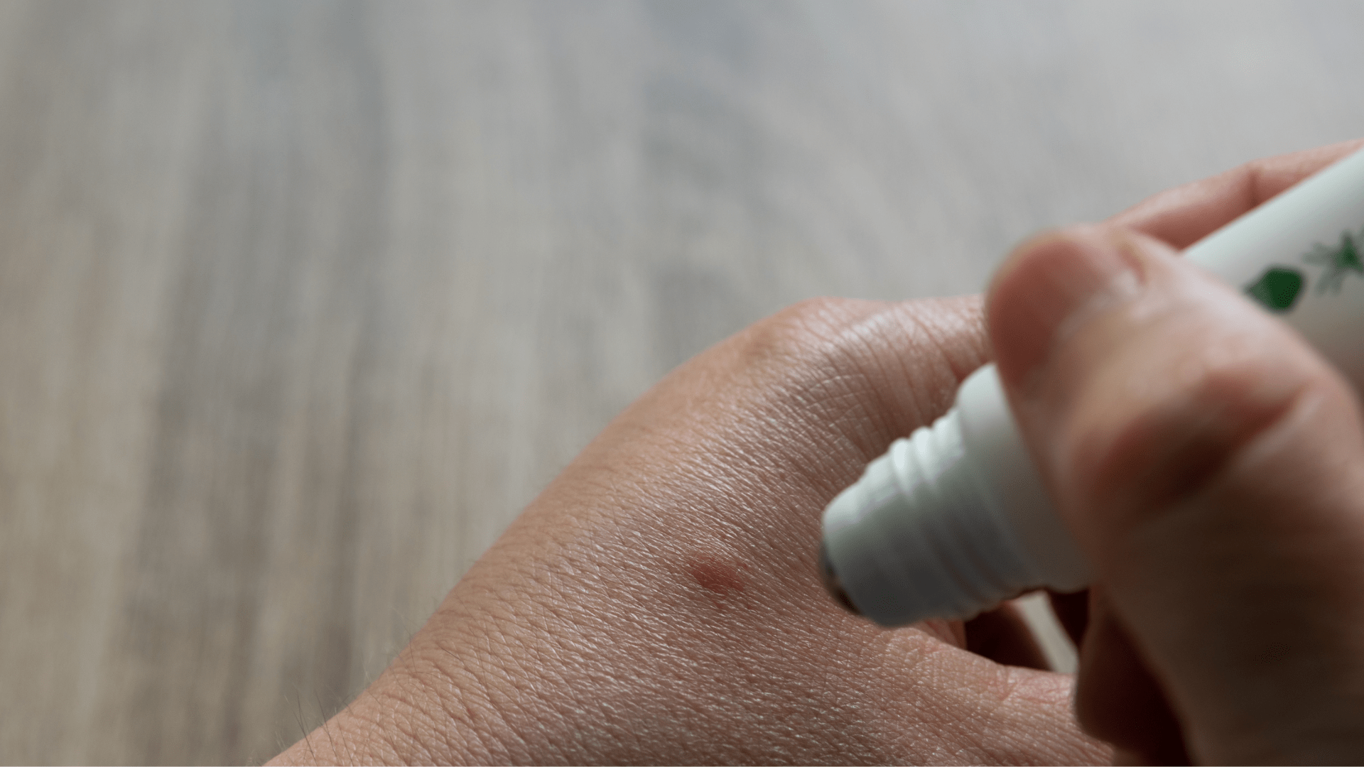 Insect Bites – Sparkle Pharmacy